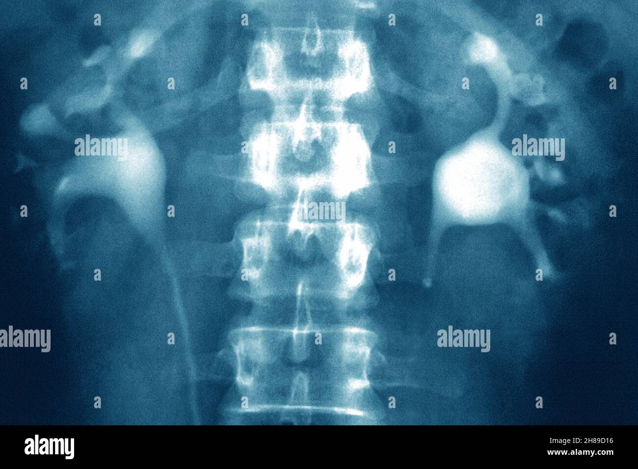 Cálculo renal immagini e fotografie stock ad alta risoluzione - Alamy