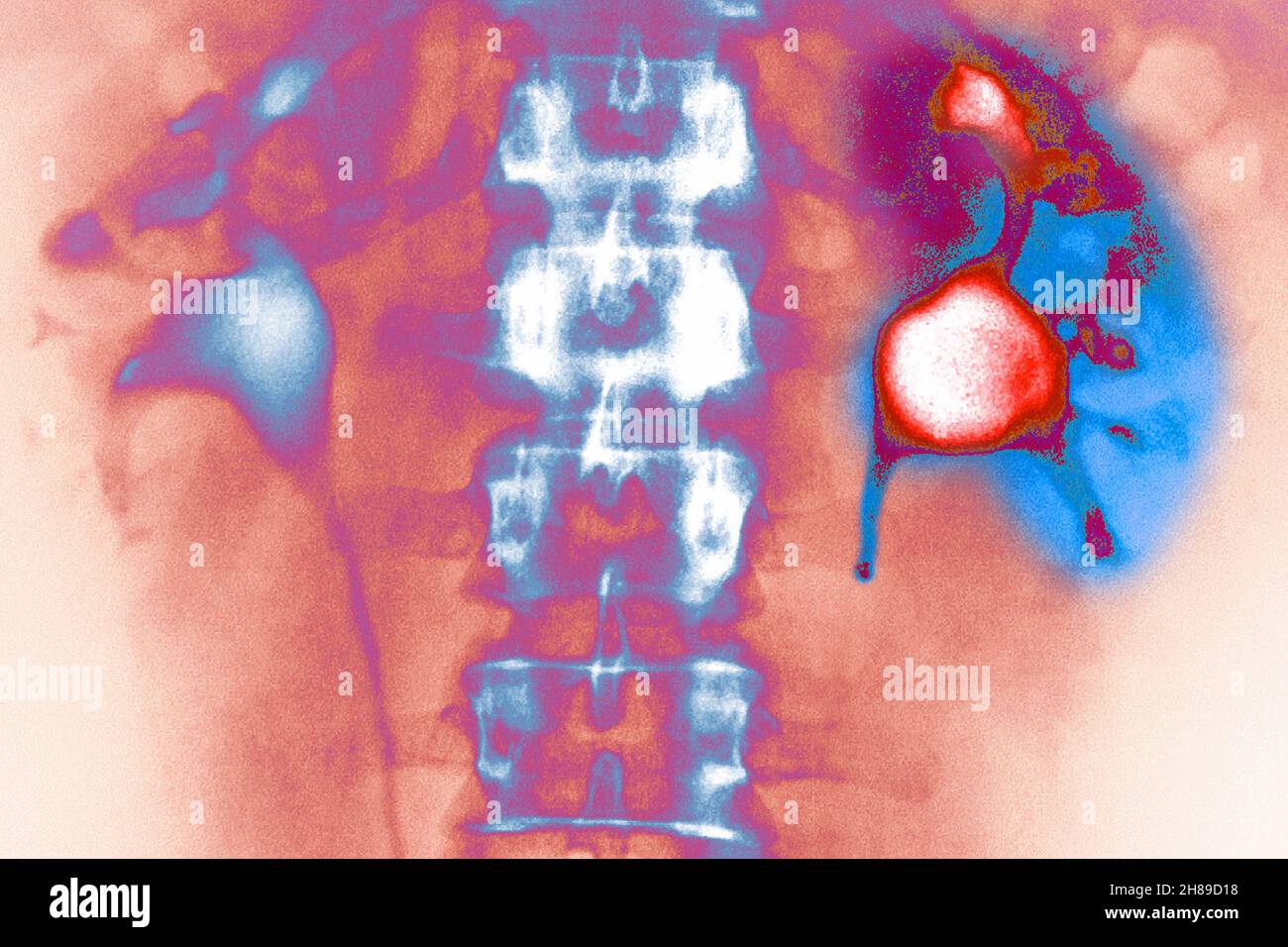 Calcolo renale immagini e fotografie stock ad alta risoluzione - Alamy
