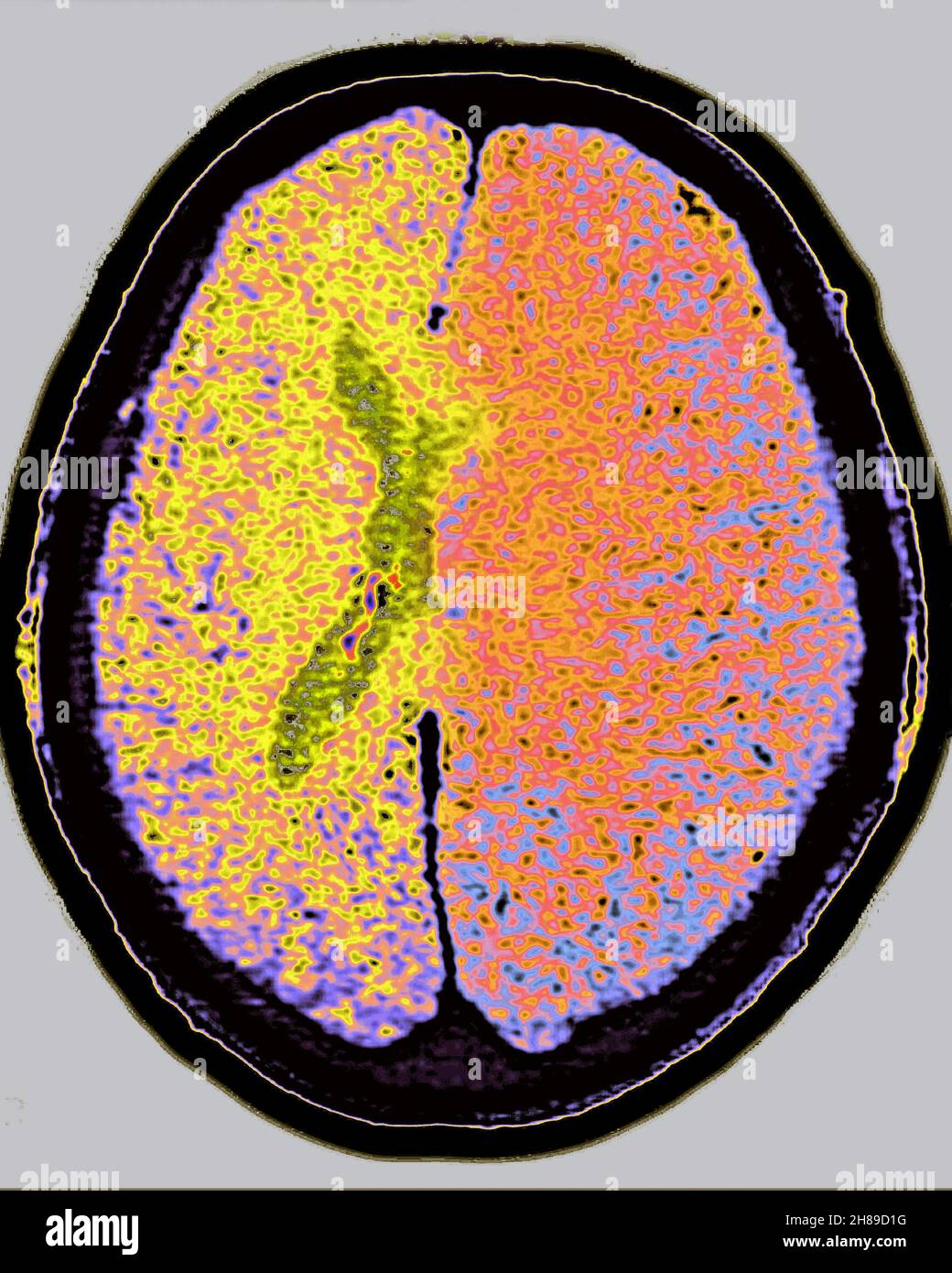 Edema Cerebrale Immagini E Fotografie Stock Ad Alta Risoluzione Alamy