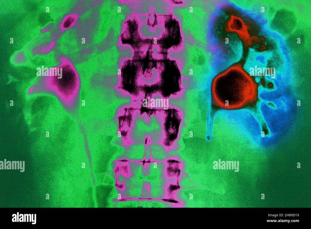 Calcolo renale immagini e fotografie stock ad alta risoluzione - Alamy