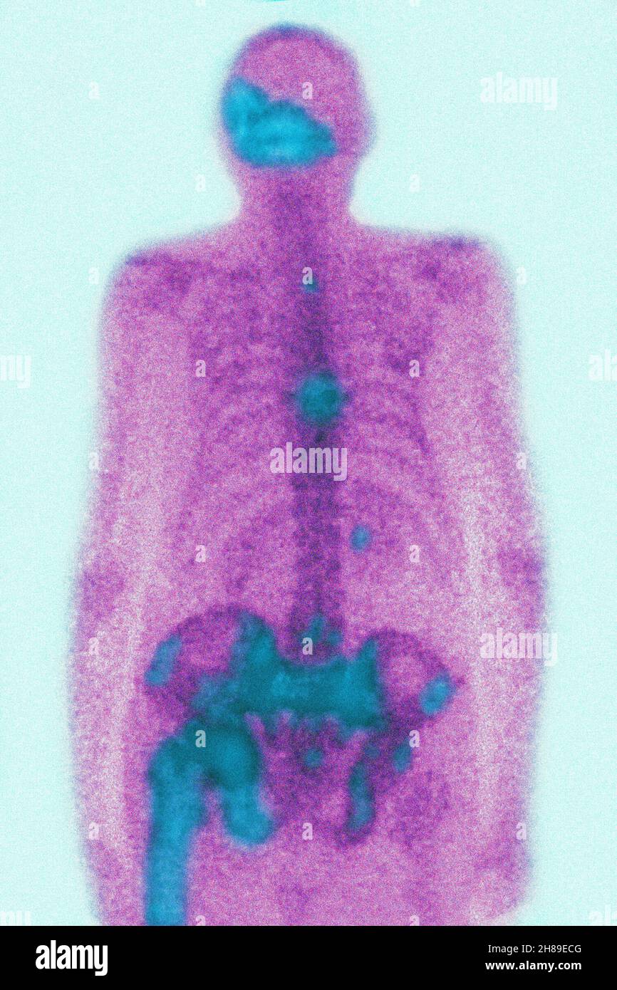 Scansione ossea di medicina nucleare immagini e fotografie stock ad alta risoluzione - Alamy