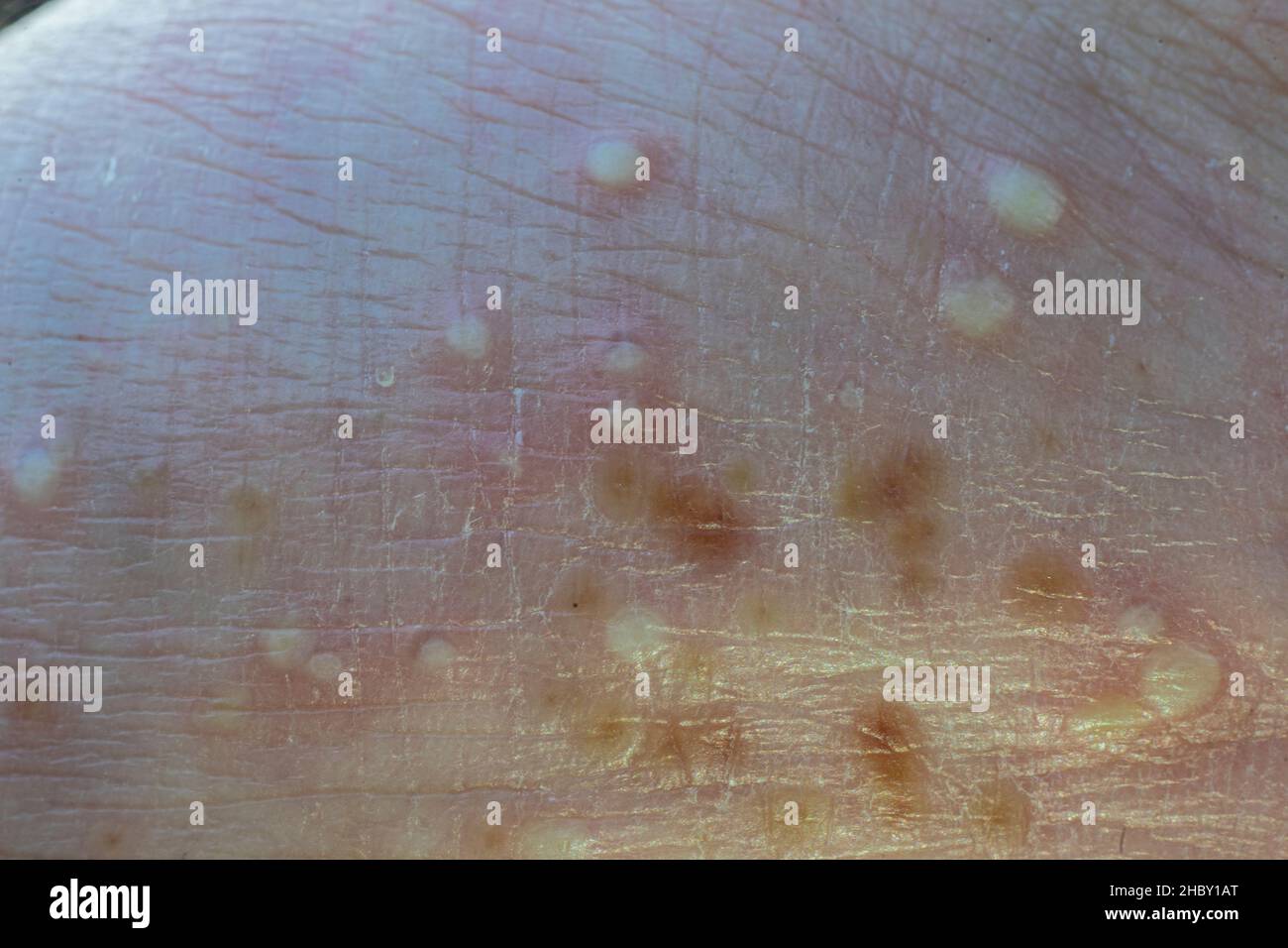 Pustole palmo immagini e fotografie stock ad alta risoluzione - Alamy