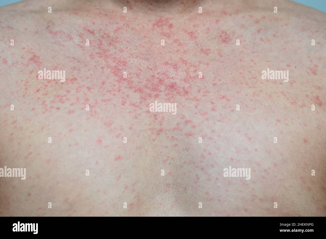 Dermatite eruzione cutanea malattia virale con immunodeficienza sul ...