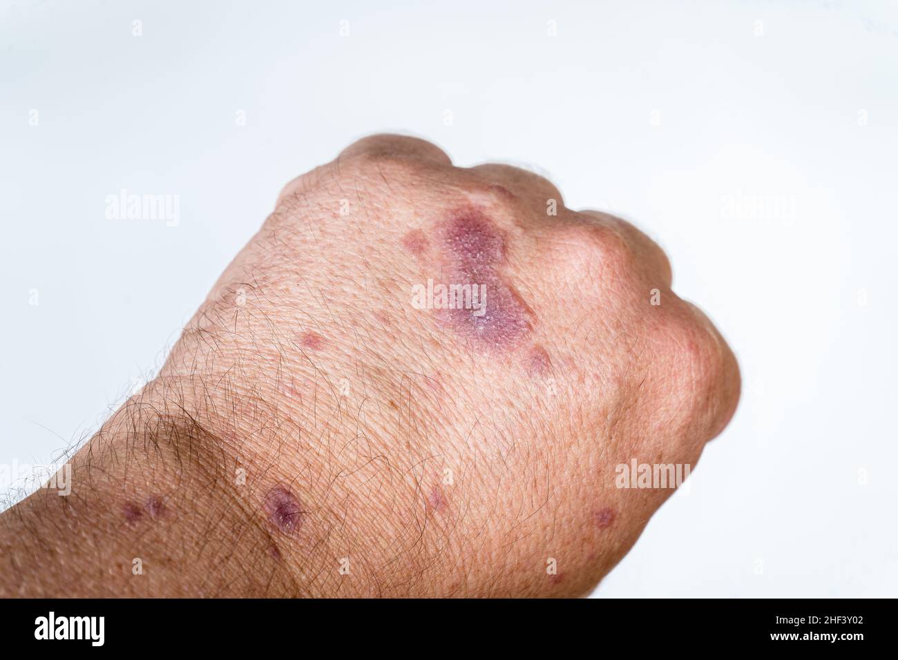 Dermatite allergica immagini e fotografie stock ad alta risoluzione - Alamy