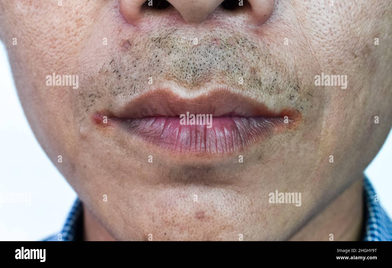 Labbro rotto e herpes labiale immagini e fotografie stock ad alta ...