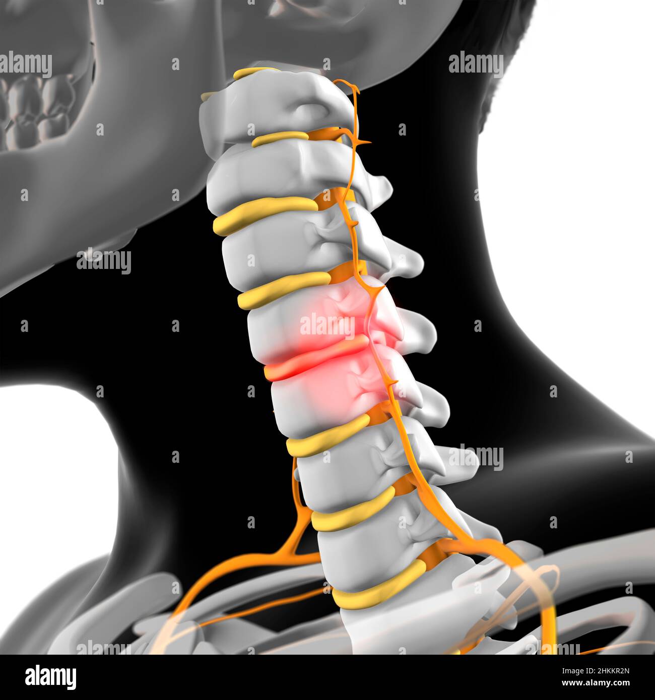 Ernia del disco spinale immagini e fotografie stock ad alta risoluzione ...