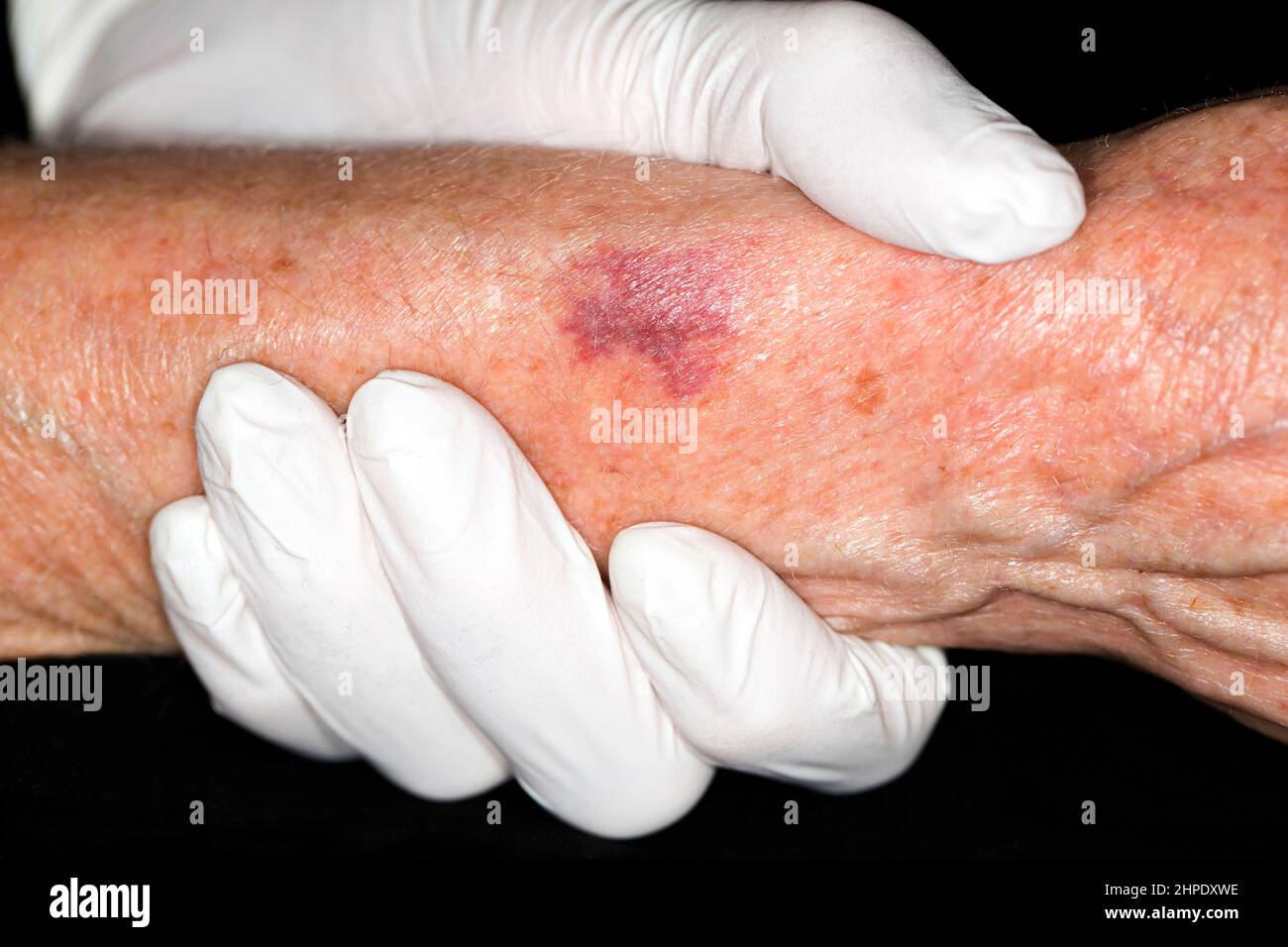 Porpora cutanea immagini e fotografie stock ad alta risoluzione - Alamy