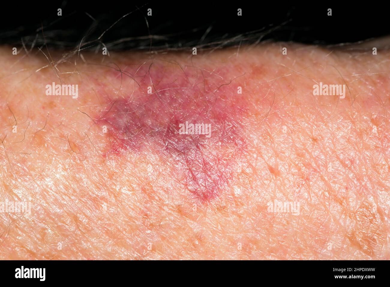 Porpora cutanea immagini e fotografie stock ad alta risoluzione - Alamy