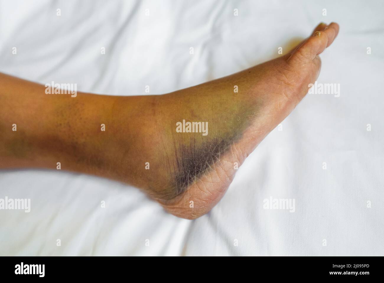 Swelling leg immagini e fotografie stock ad alta risoluzione - Alamy