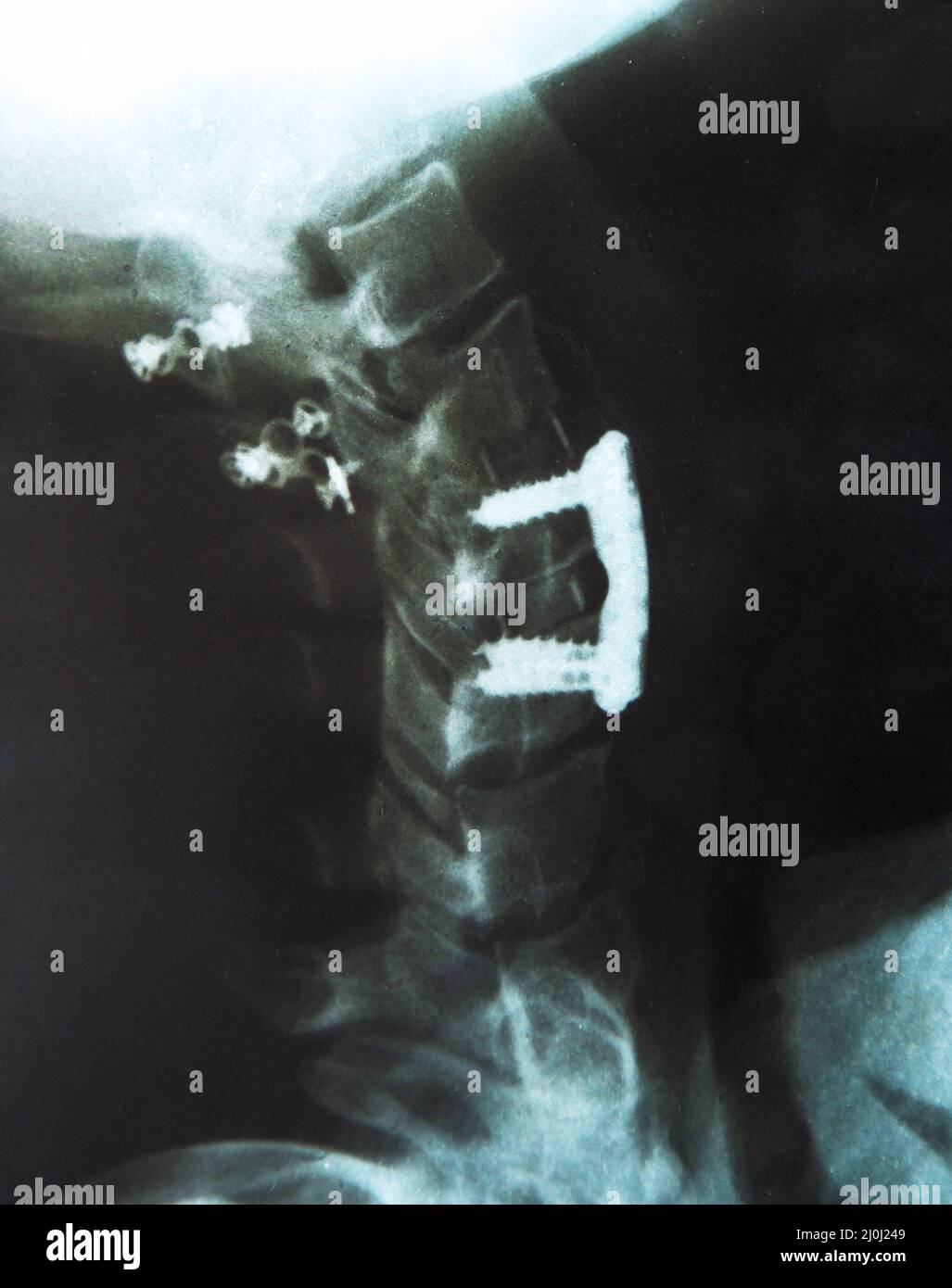 Colonna vertebrale immagini e fotografie stock ad alta risoluzione - Alamy
