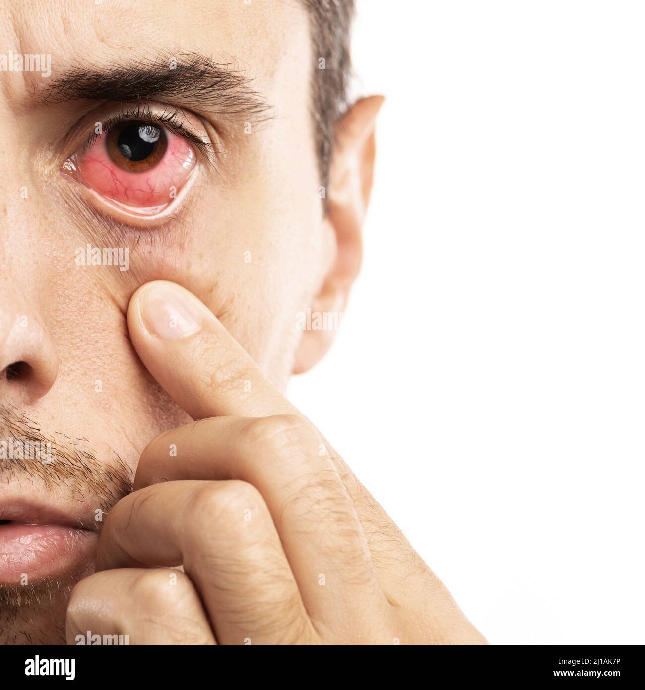 Emorragia oculare immagini e fotografie stock ad alta risoluzione - Alamy