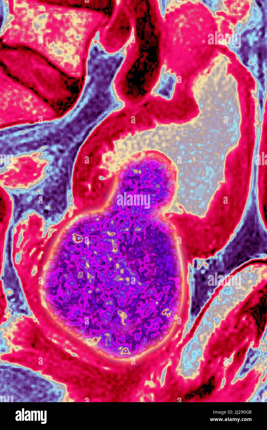 Prostatico benigno immagini e fotografie stock ad alta risoluzione - Alamy