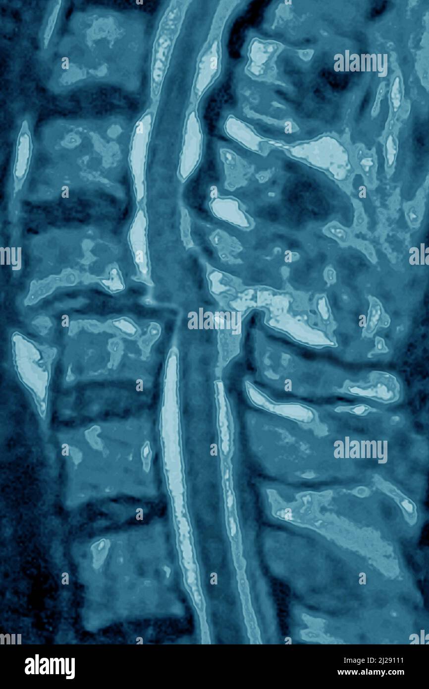 Risonanza magnetica rachide cervicale immagini e fotografie stock ad ...