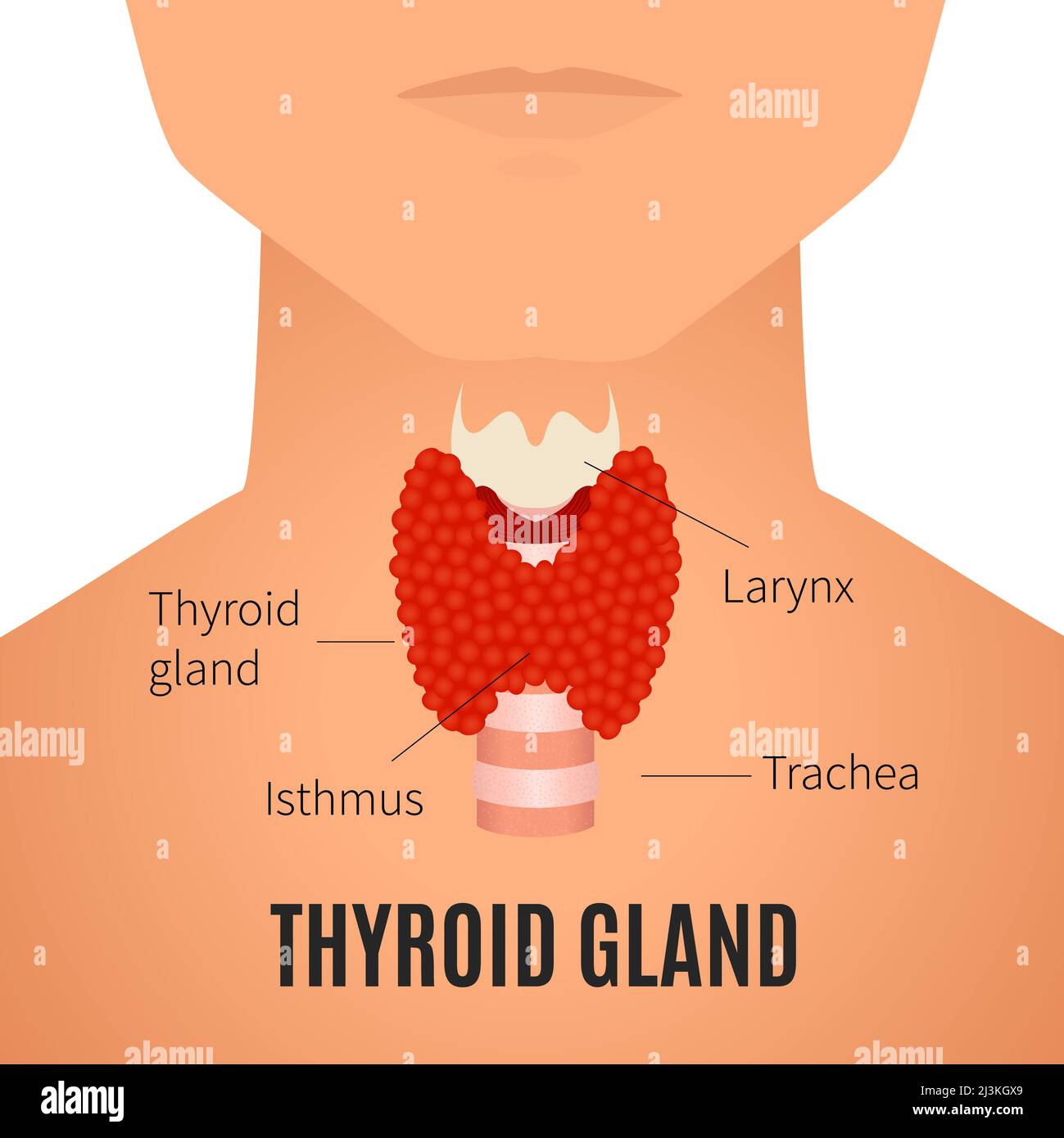 Gozzo tiroide immagini e fotografie stock ad alta risoluzione - Alamy