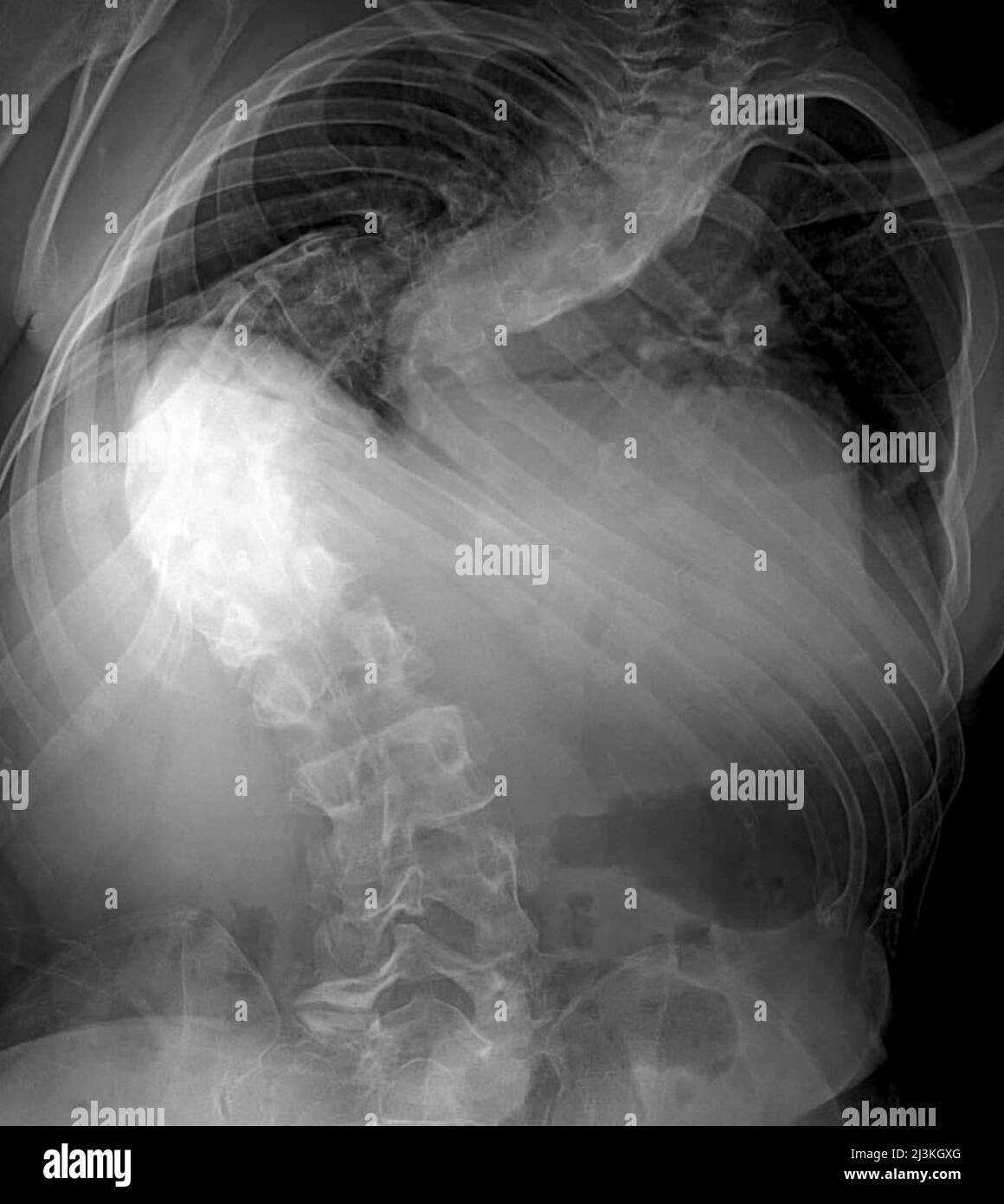 Radiografia della scoliosi immagini e fotografie stock ad alta ...