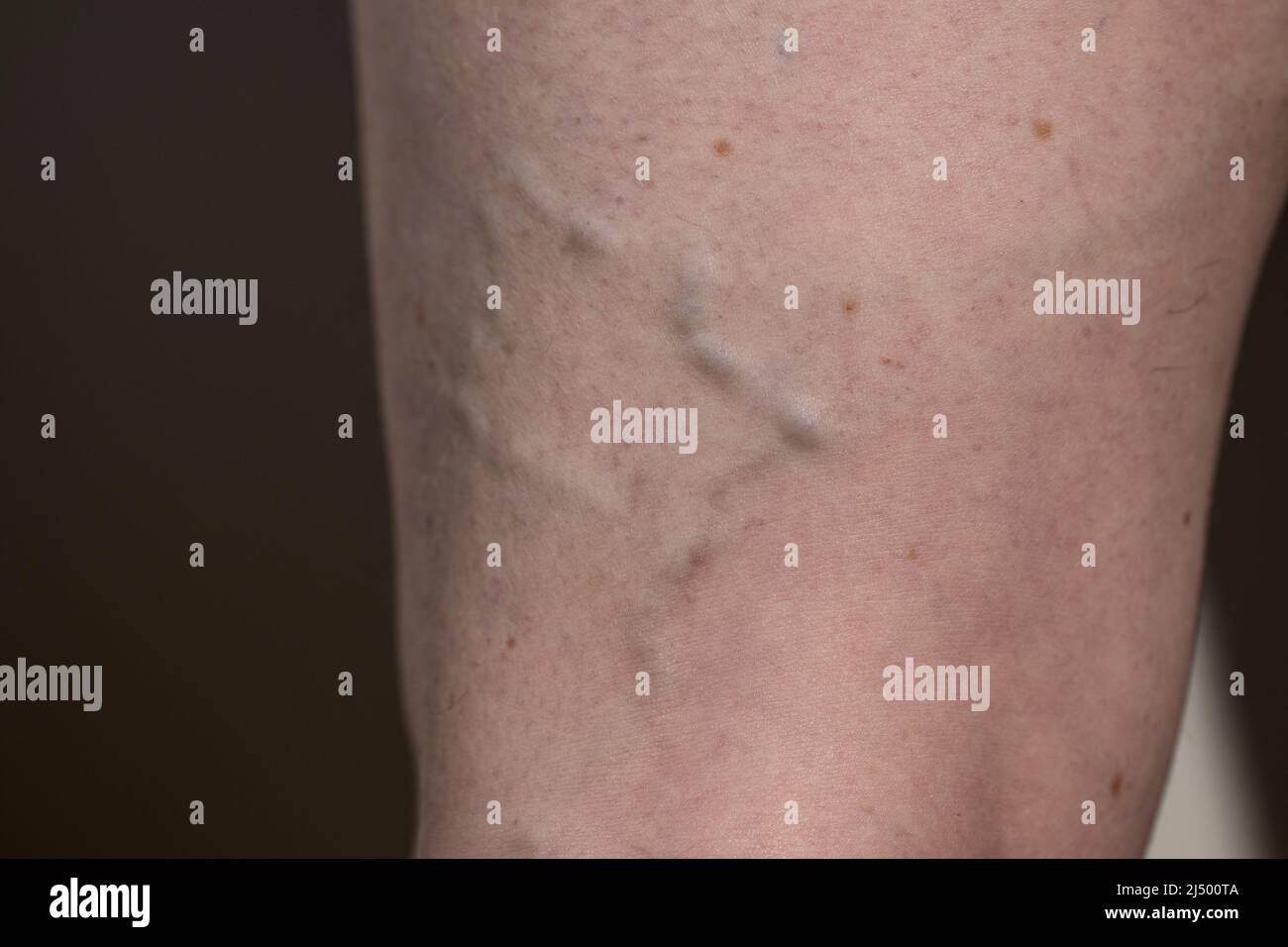 Ulcera venosa gamba immagini e fotografie stock ad alta risoluzione - Alamy