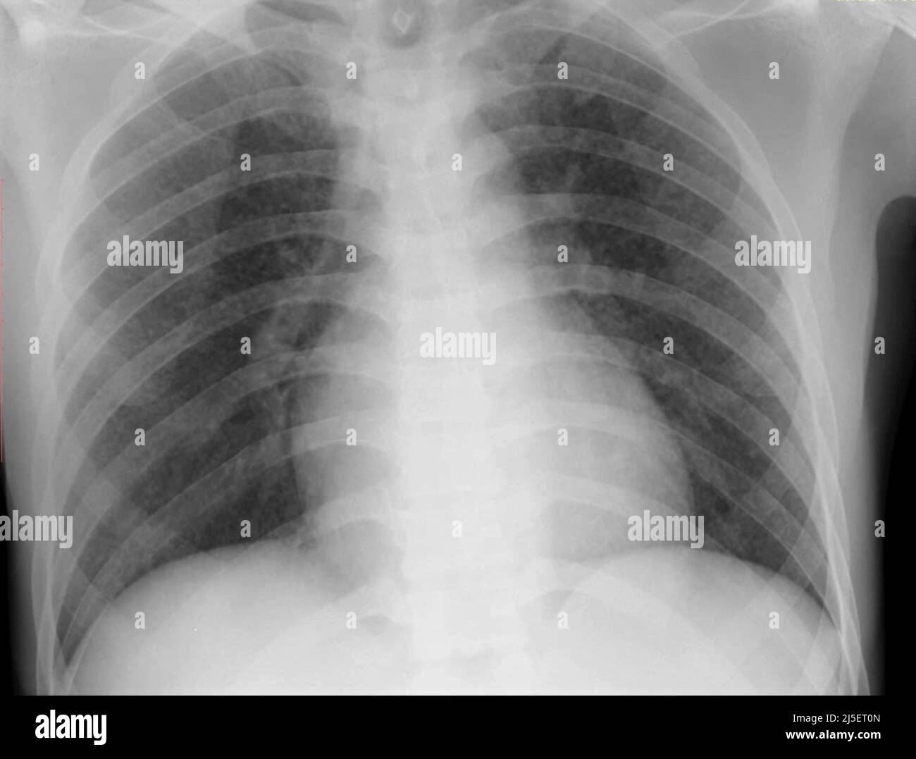 Noduli polmonari immagini e fotografie stock ad alta risoluzione - Alamy