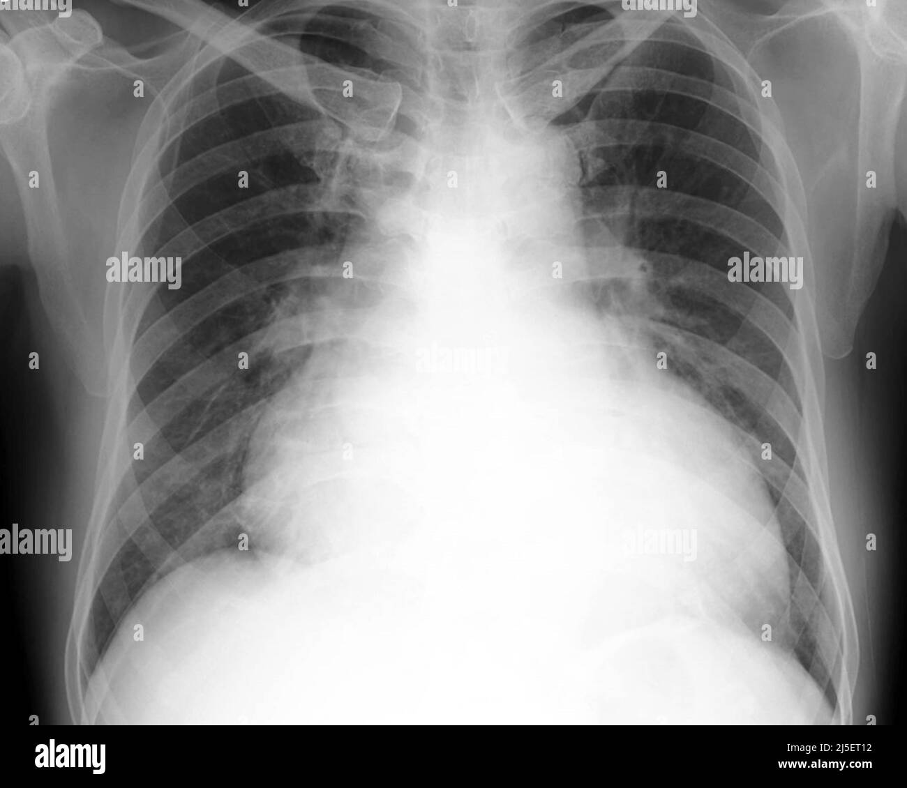 Radiografia del cuore immagini e fotografie stock ad alta risoluzione ...