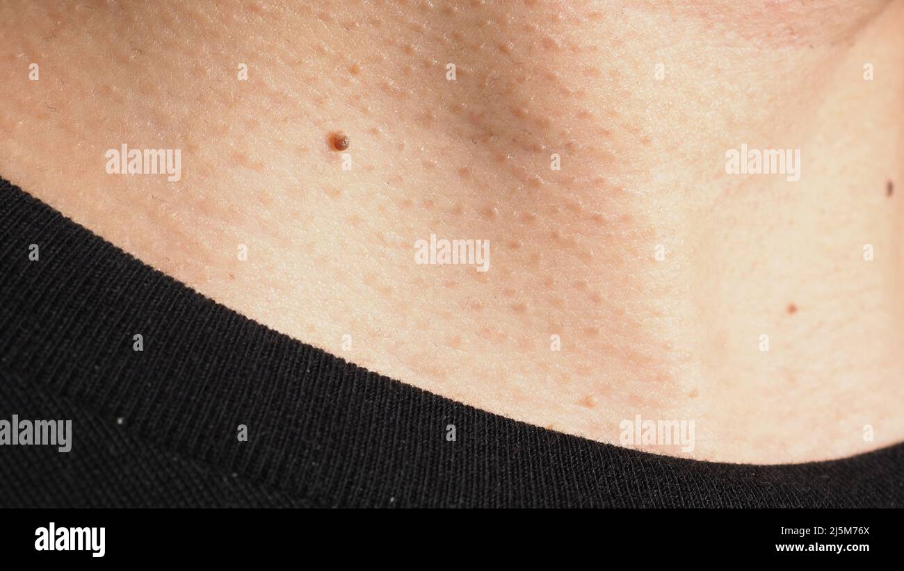 Pelle di verruca immagini e fotografie stock ad alta risoluzione ...