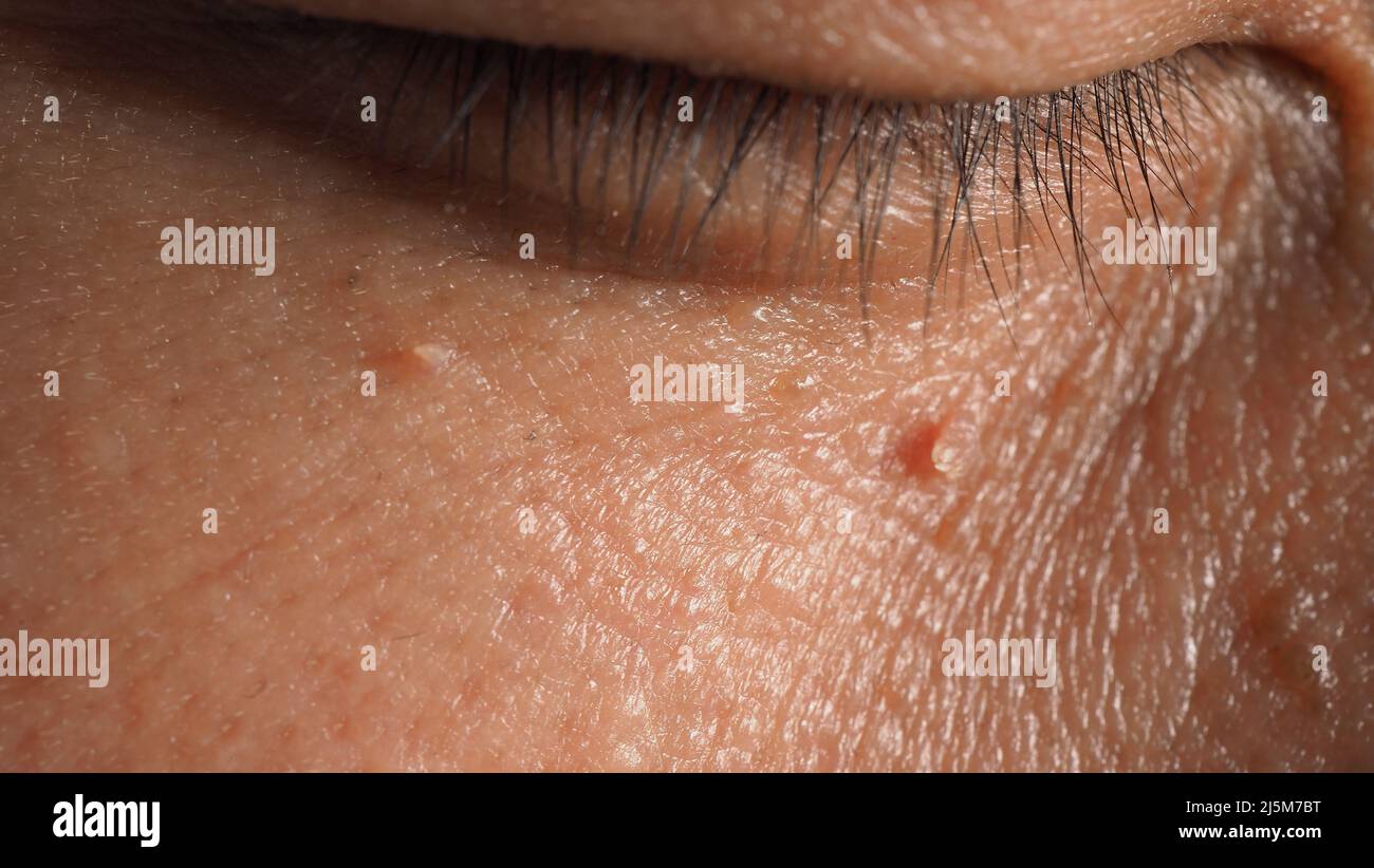 Papilloma Della Pelle Immagini e Fotos Stock - Alamy