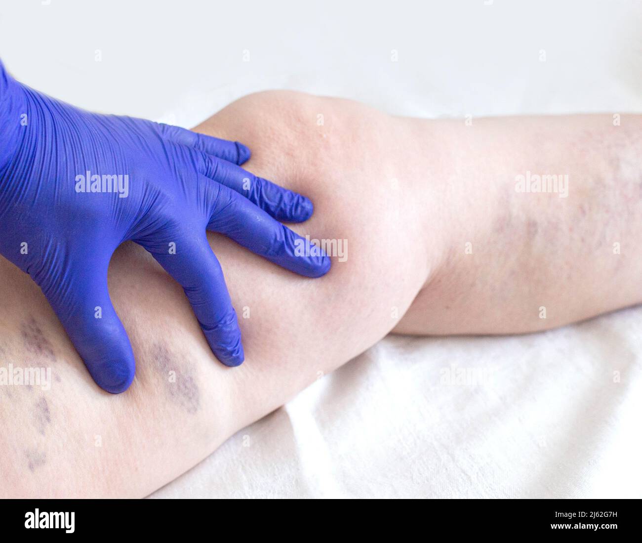 Ulcera venosa gamba immagini e fotografie stock ad alta risoluzione - Alamy