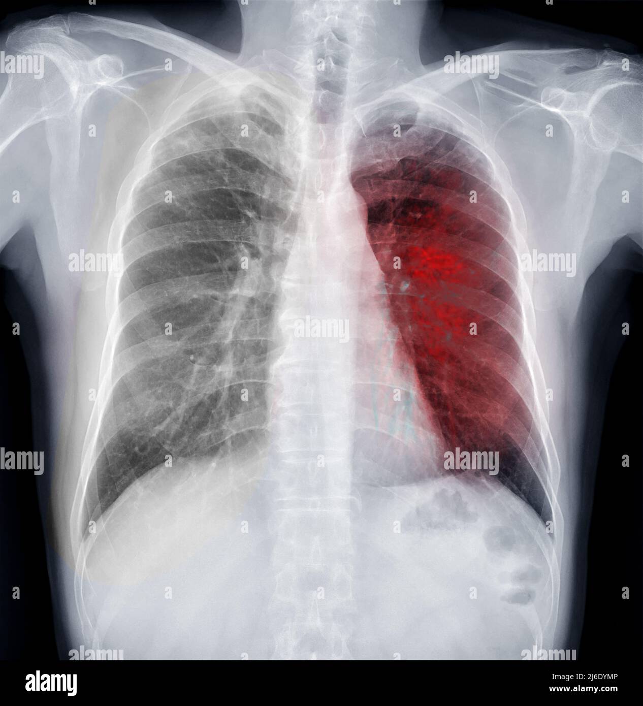 Radiografia toracica del torace umano o del polmone per rilevare la ...