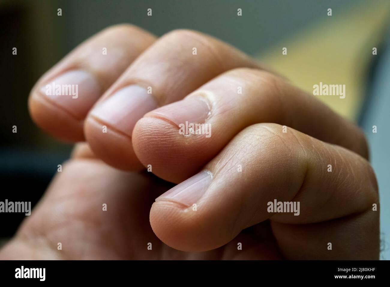 Unghia sana immagini e fotografie stock ad alta risoluzione - Alamy