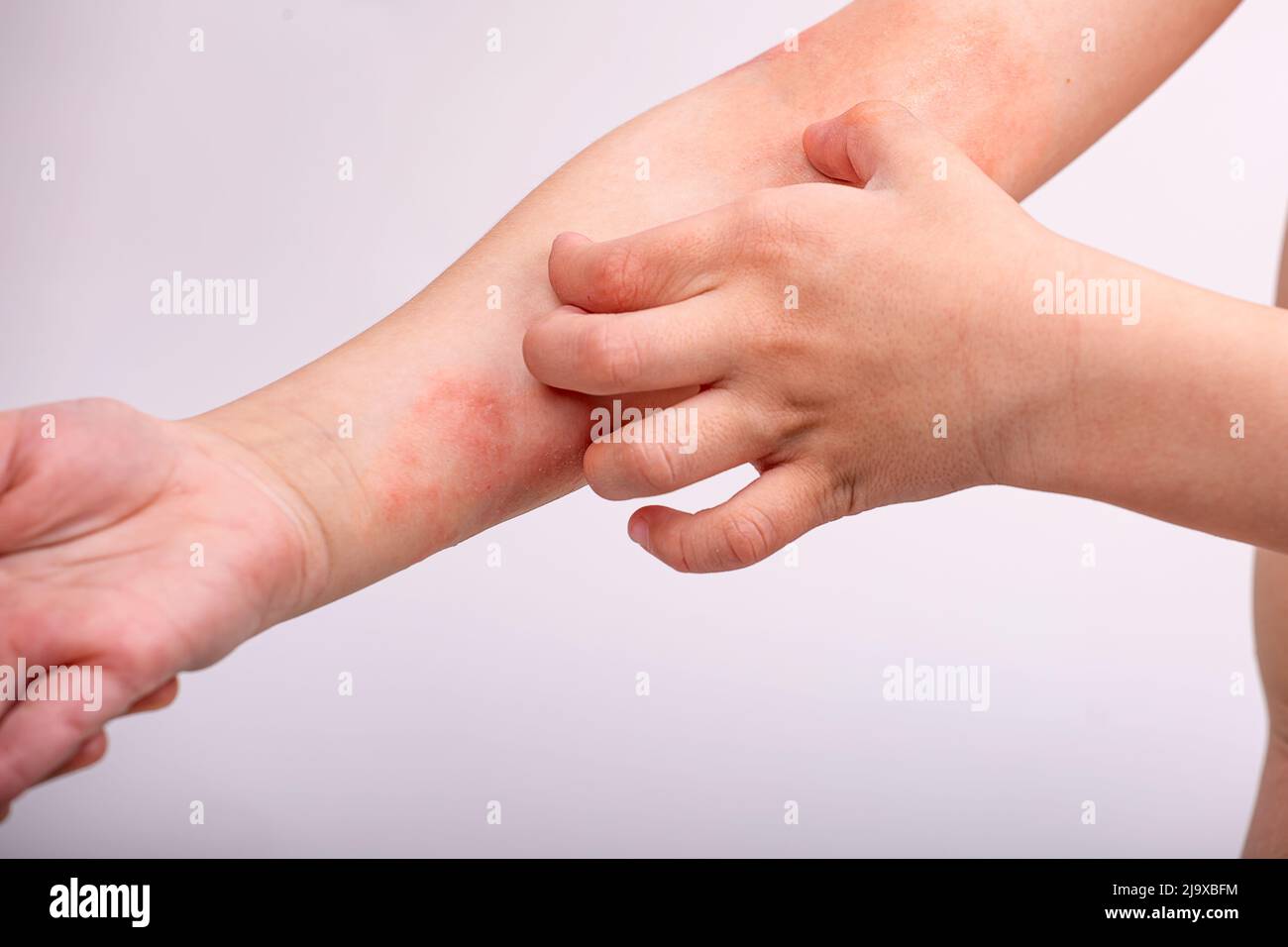 Dermatite alle mani immagini e fotografie stock ad alta risoluzione - Alamy