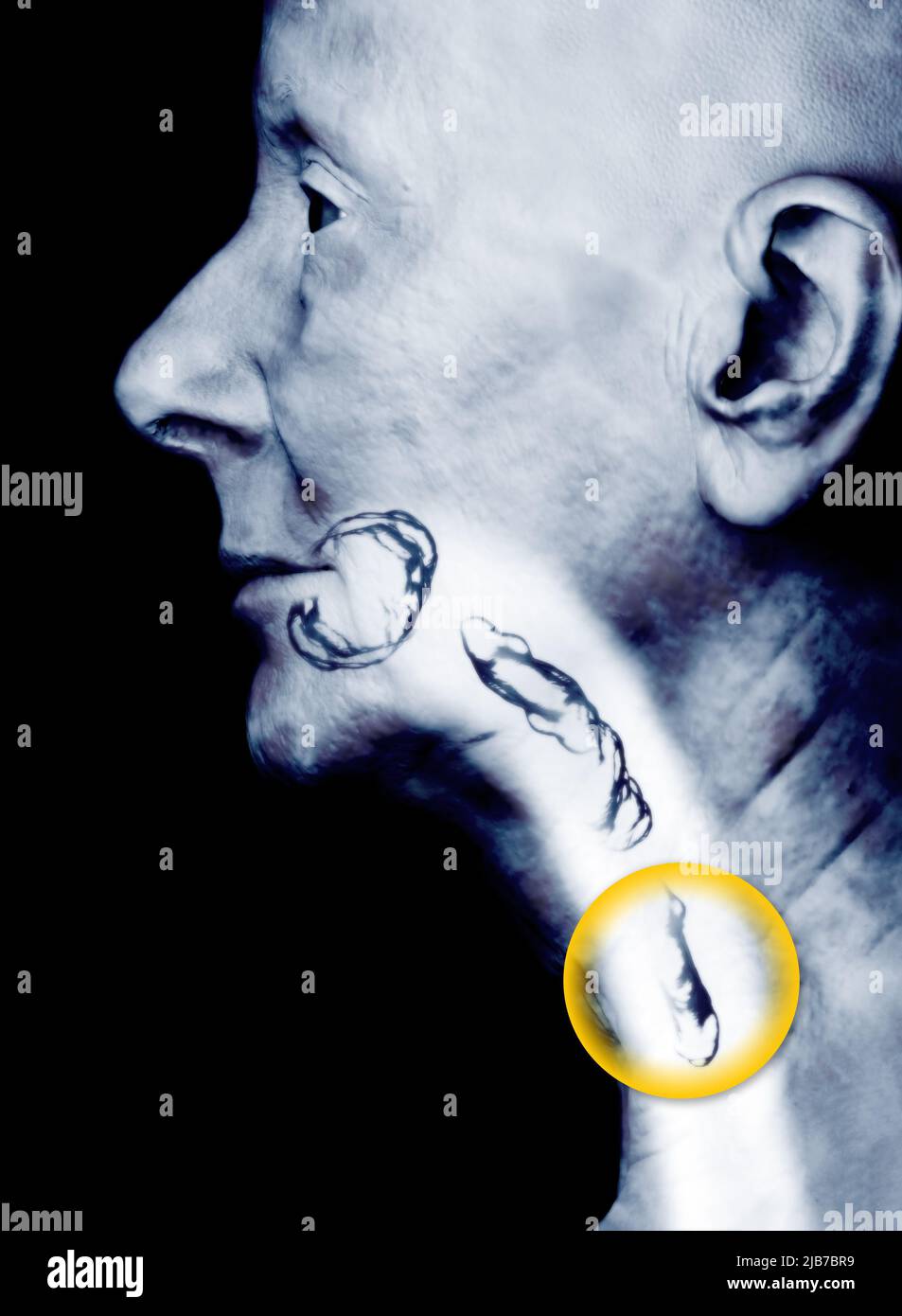 Disturbi della deglutizione, disfagia. Disfagia faringea ed esofagea ...