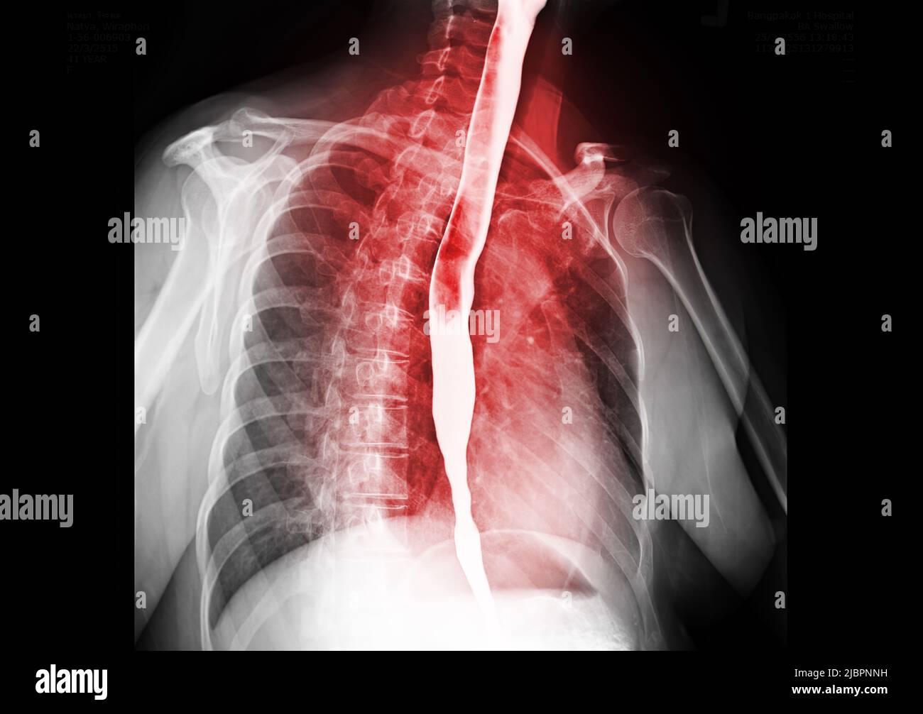 Esophagus cancer immagini e fotografie stock ad alta risoluzione - Alamy