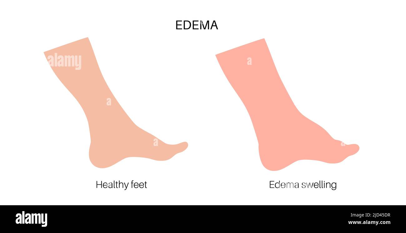 Edema ai piedi immagini e fotografie stock ad alta risoluzione - Alamy