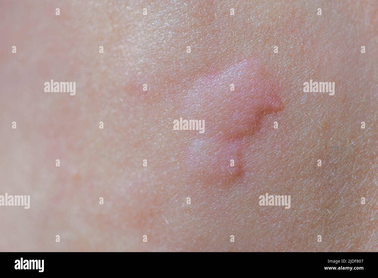 Orticaria sulla pelle. Macchie rosse di una reazione allergica sulla ...