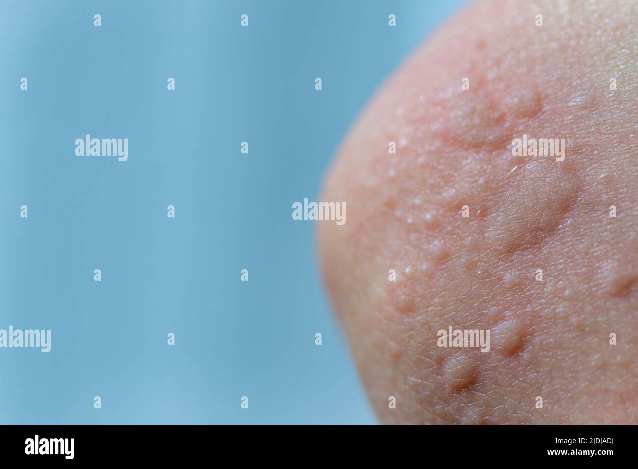 Orticaria sulla pelle. Macchie rosse di una reazione allergica sulla ...