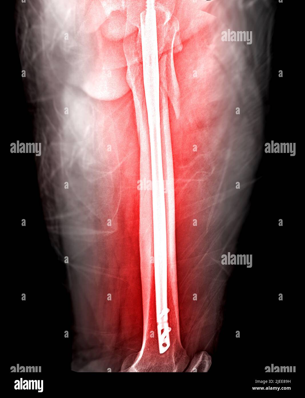 Articolazione sacroiliaca di tomografia computerizzata immagini e ...