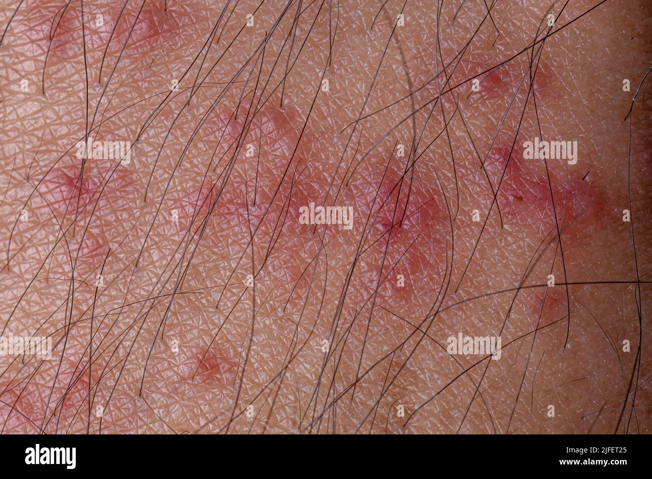 Allergia pelle punture acari immagini e fotografie stock ad alta ...