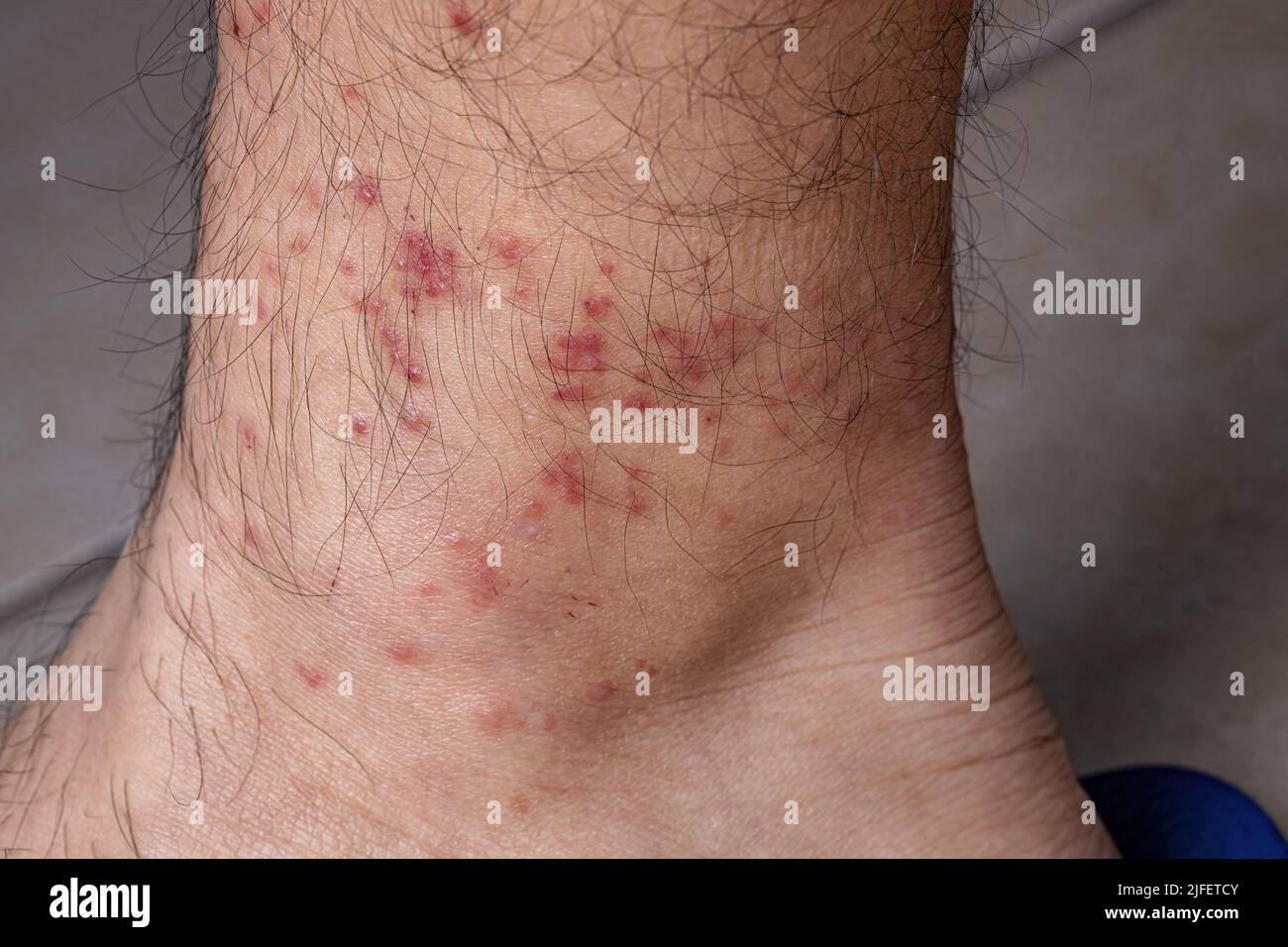Allergia pelle punture acari immagini e fotografie stock ad alta ...