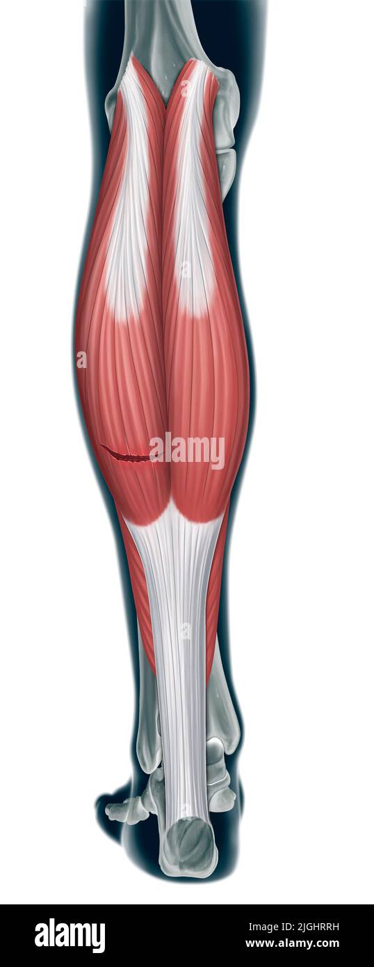 Muscolo del polpaccio umano immagini e fotografie stock ad alta ...