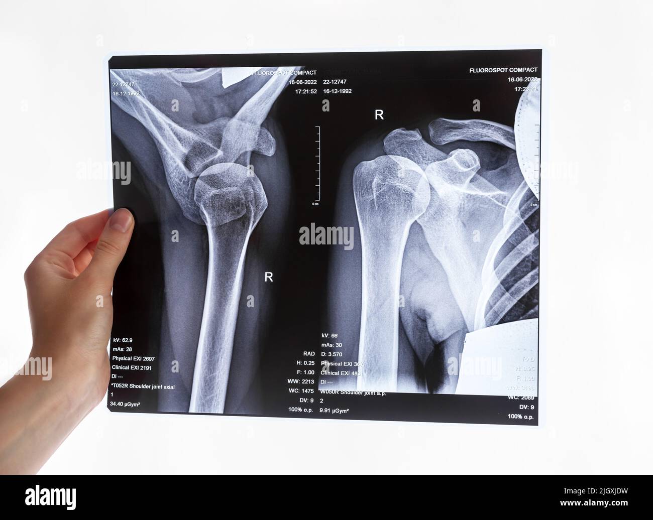 Radiografia della spalla immagini e fotografie stock ad alta ...