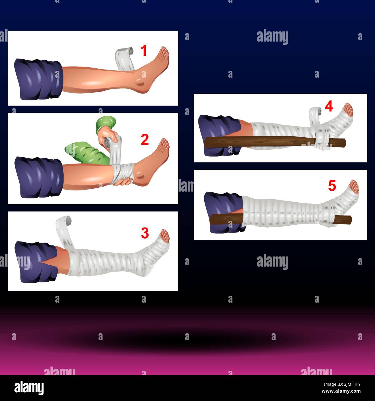 Costola rotta immagini e fotografie stock ad alta risoluzione - Alamy