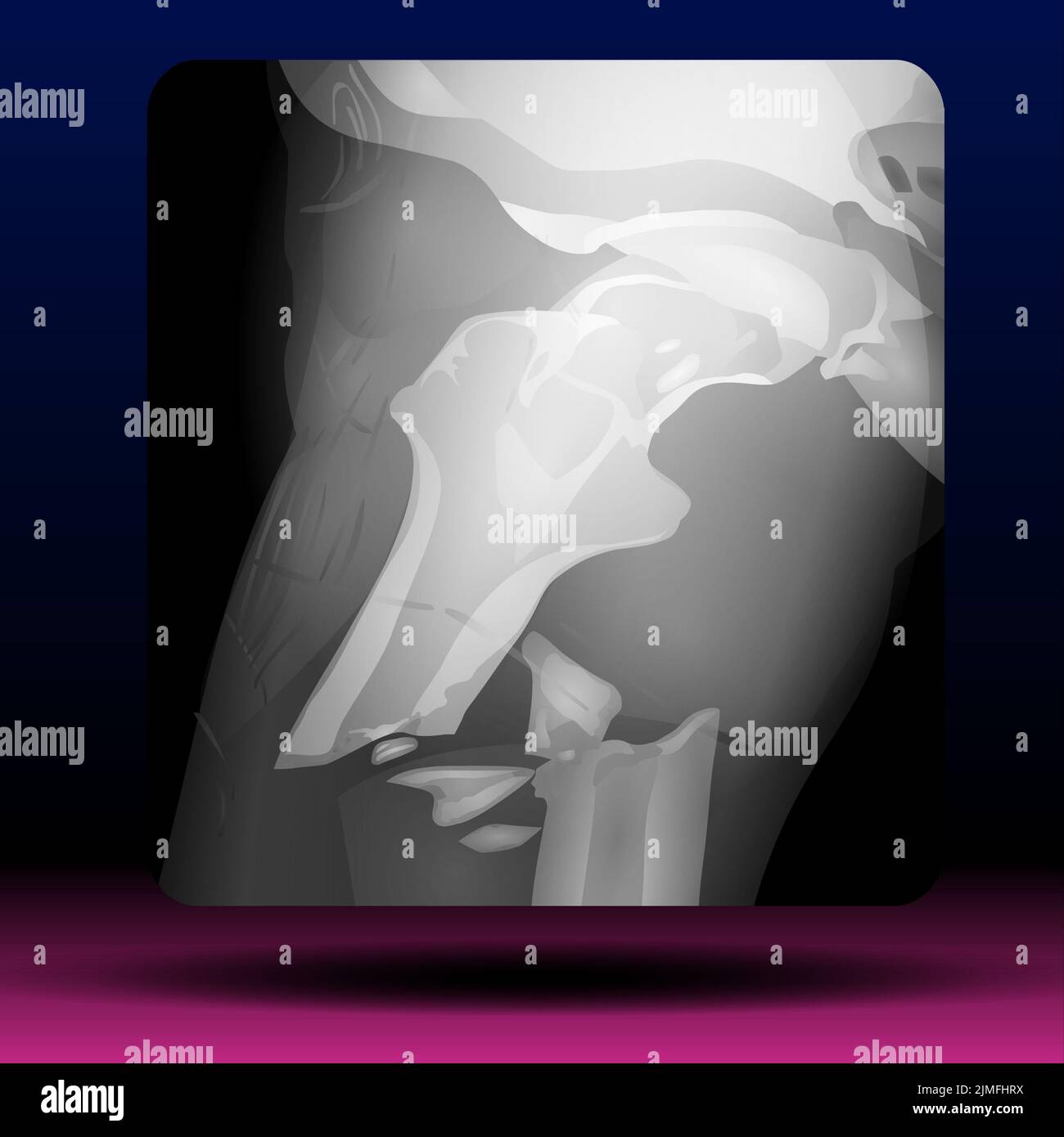 Frattura del femore immagini e fotografie stock ad alta risoluzione - Alamy