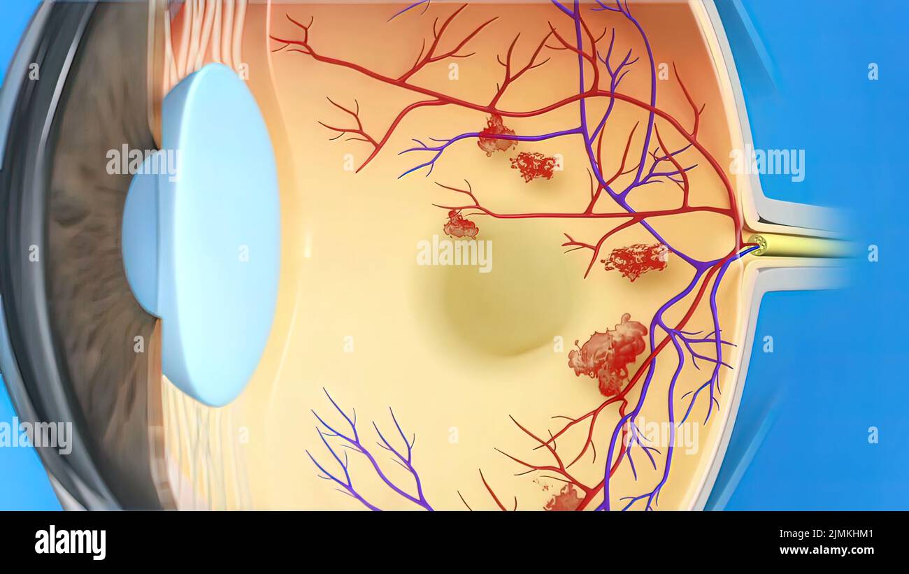 Edema maculare diabetico immagini e fotografie stock ad alta ...