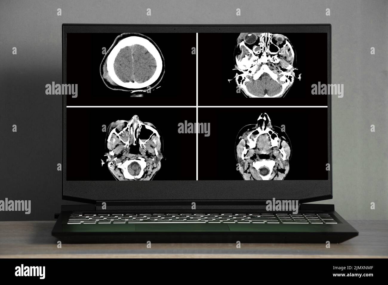 Anatomia tc encefalo immagini e fotografie stock ad alta risoluzione ...