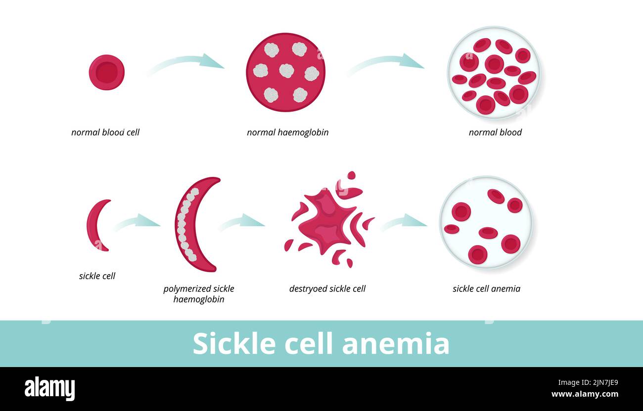 Anemia falciforme (malattia) si verifica a causa di cellule falciformi ...