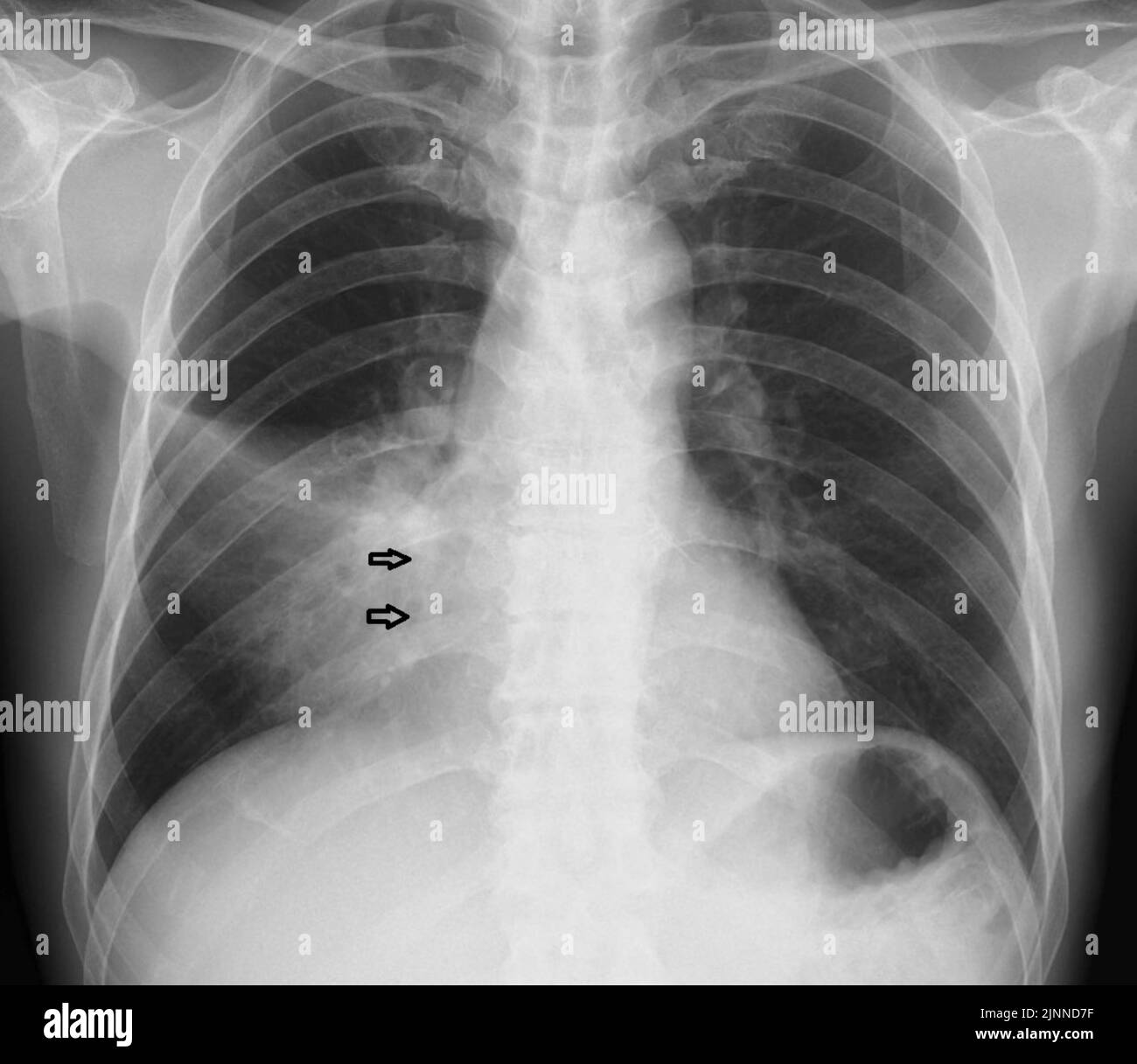Radiografia toracica immagini e fotografie stock ad alta risoluzione ...