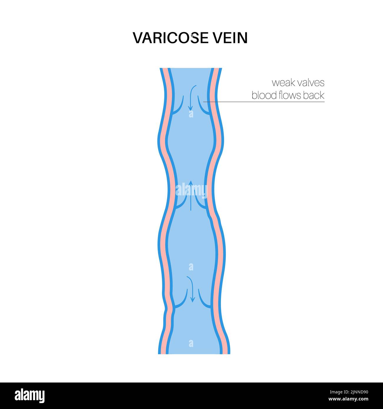 Trombosi delle vene delle gambe Immagini senza sfondo e Foto Stock ...