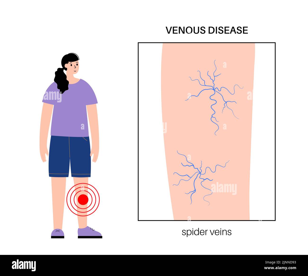 Diagramma a ragno immagini e fotografie stock ad alta risoluzione - Alamy
