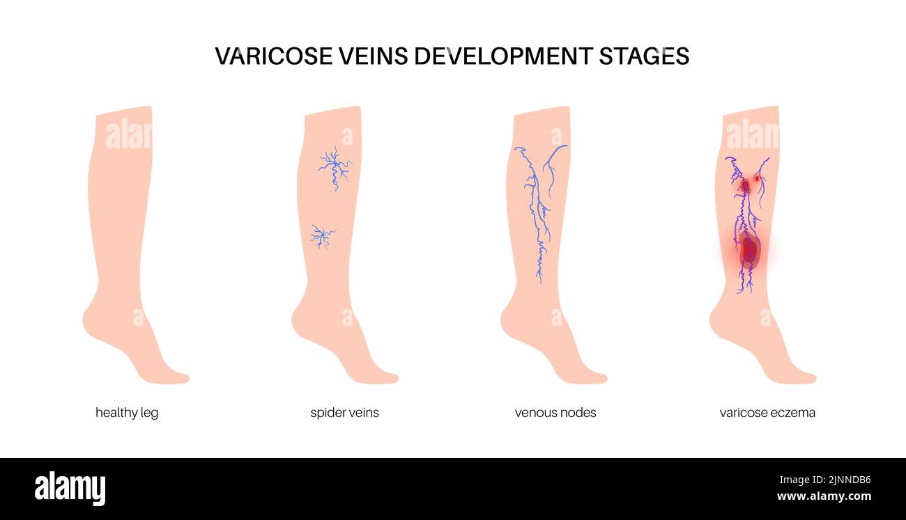 Ulcera venosa immagini e fotografie stock ad alta risoluzione - Alamy