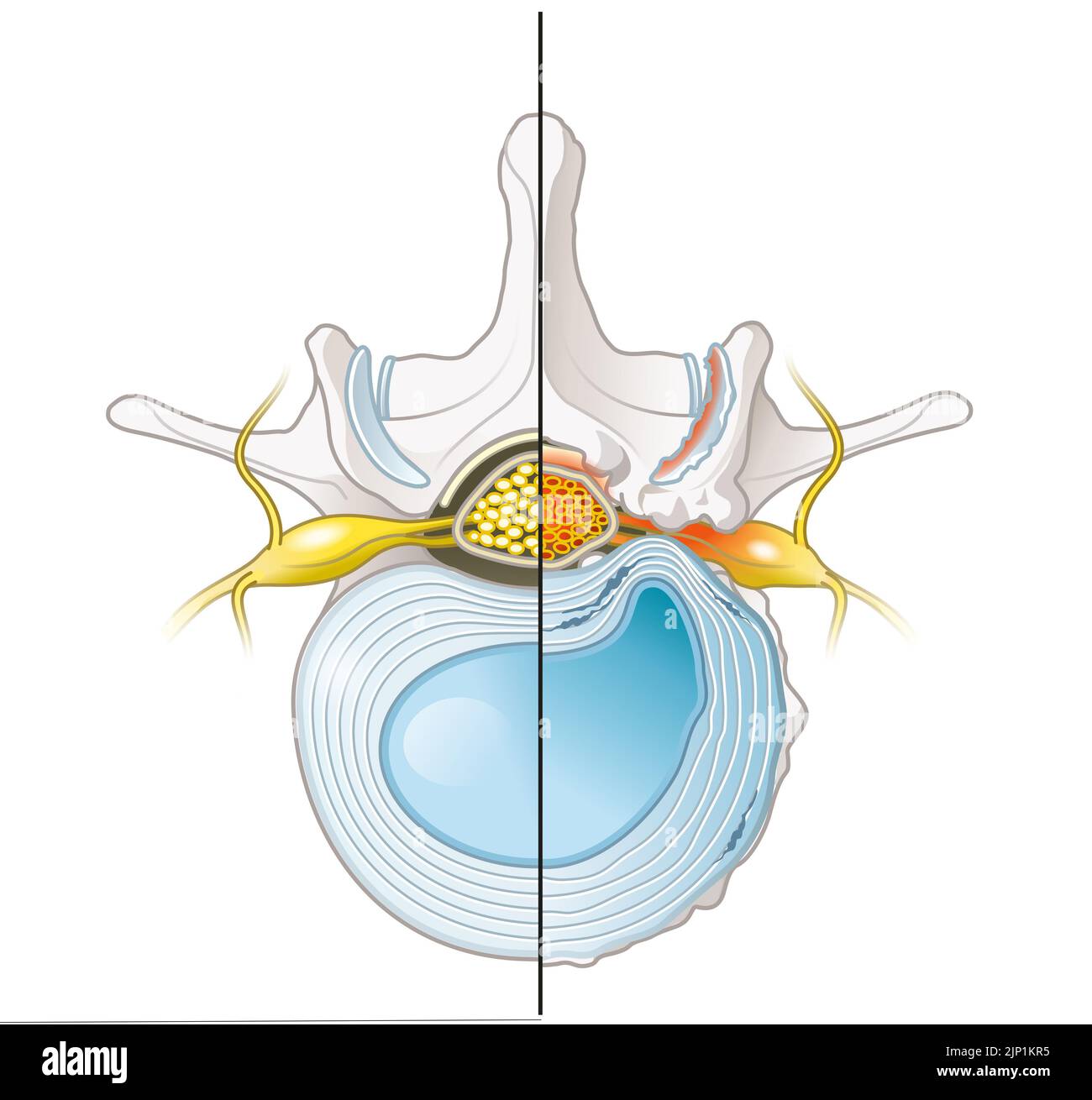 Illustrazione che mostra stenosi del canale spinale vertebra lombare ...