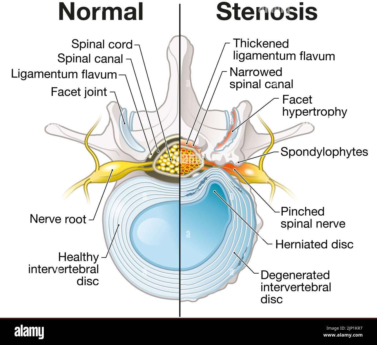 Illustrazione che mostra stenosi del canale spinale vertebra lombare ...