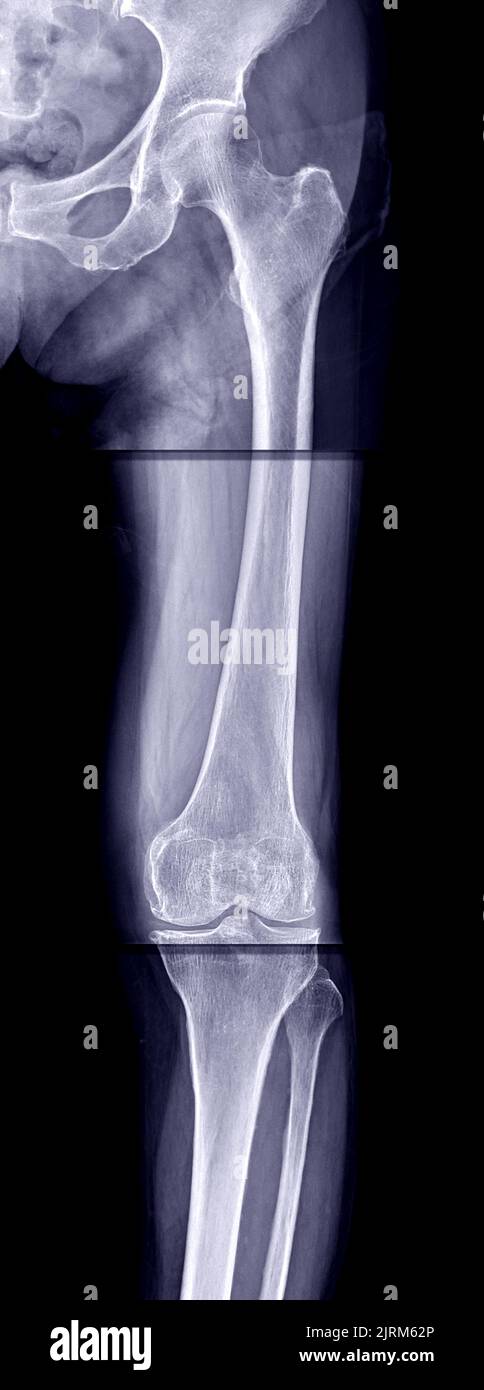 Trauma femore immagini e fotografie stock ad alta risoluzione - Alamy